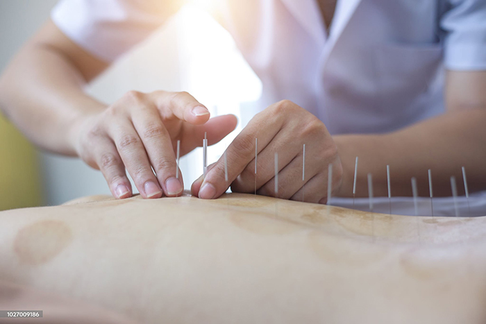 Acupuncture In Guildford | Kinesis Clinic